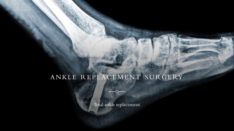 Ankle Replacement Surgery: Use, Procedure, Risks