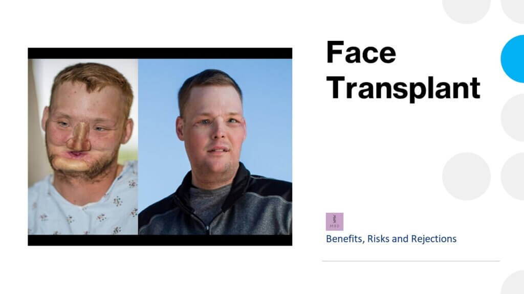 Face Transplant: Benefits, Risks and Rejections